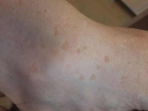 Красные пятна на ногах фото и названия