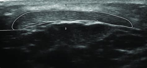 Patellar Tendon Cross Sectional Area 1 Subcutaneous Fat 2 Download Scientific Diagram