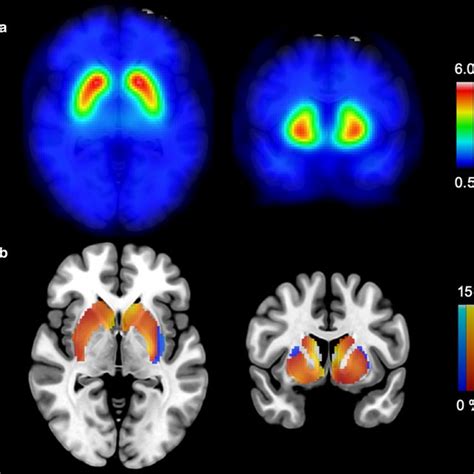 Voxelwise Map Of Sex Differences In The Striatum A Average SBR Download Scientific Diagram
