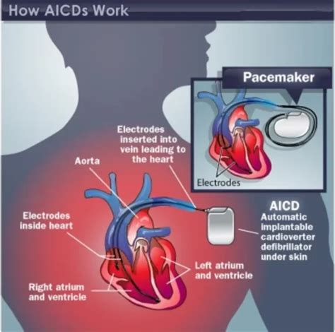 Implantable Cardioverter Defibrillator Vs Pacemaker