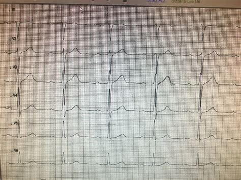 Are These Hyperacute T Waves What Is Your Recommendation For The Team In These Two Cases