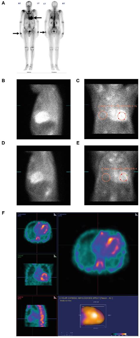 Pyp Scan A For Metastatic Prostate Cancer Showing An Incidental