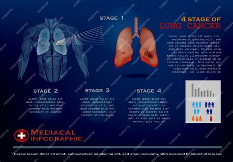 Premium Vector 4 Stage Of Lung Cancer Infographic