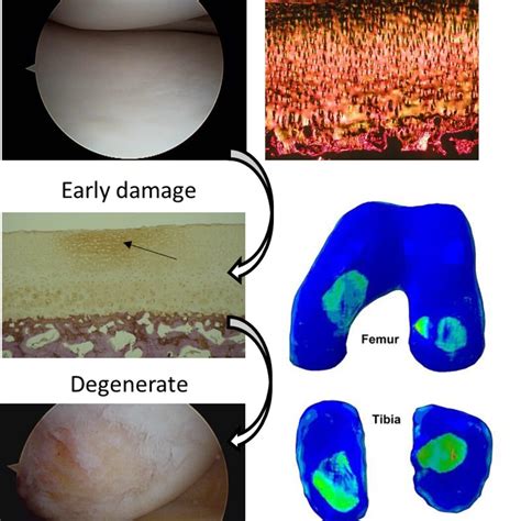 Osteoarthritis And Cartilage Tissue Engineering