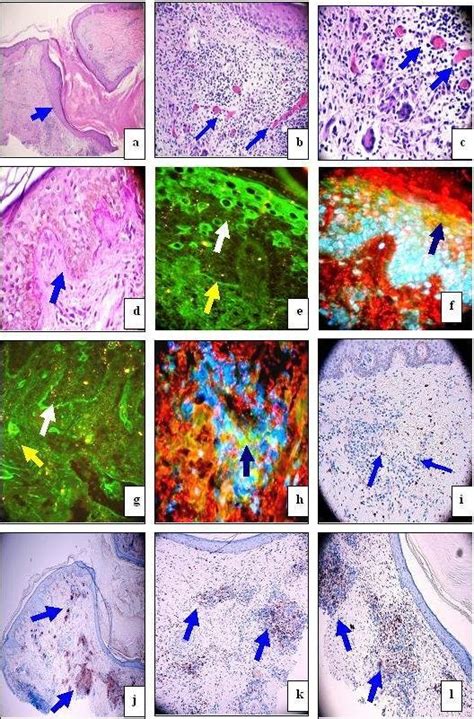 A Hande Section Demonstrating Prominent Follicular Plugging Blue Download Scientific Diagram