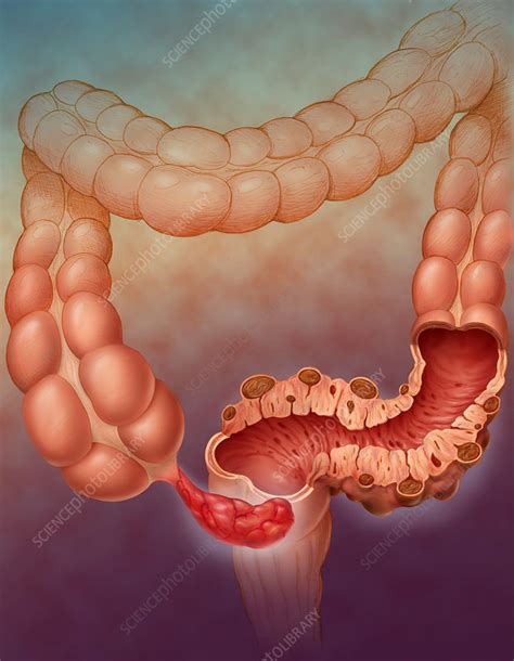 Appendicitis And Diverticulitis Stock Image C0014967 Science Photo Library