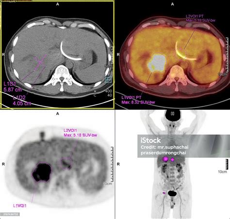 A Pet Ct Scan Reveals Cholangiocarcinoma With Suspected Metastatic