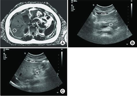 Example Of Fat Quantification By Ultrasonography And Magnetic Resonance Download Scientific