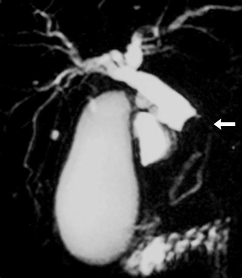 Unusual Presentation Of A Distal Cholangiocarcinoma Abstract