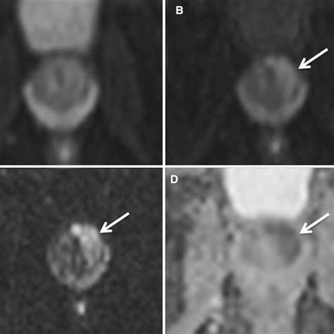 Stromal Benign Prostatic Hyperplastic Bph Nodule Vs Transition Zone Download Scientific