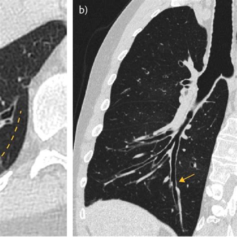 Imaging Findings In Bronchiectasis A The Arrow Points To Cylindrical