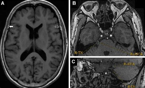 Temporalis Muscle Atrophy In A Patient With Right Sided Tn A Download Scientific Diagram