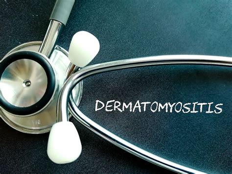 Dermatomyositis Symptoms Causes Diagnosis And Treatment