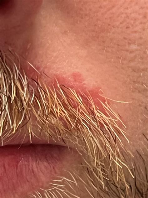 Beard Rash Advice R Beards