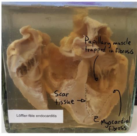 42 Löfflers Endocarditis Flashcards Quizlet
