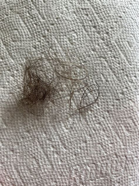 Is This The Beginning Of Bupropion Hair Loss Rbupropion