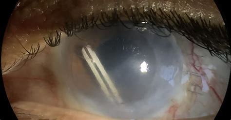 failed tube shunt extension after glaucoma surgery imgur