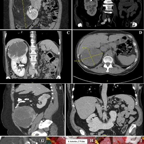 Open Partial Nephrectomy When A Non Flank Approach Is Required