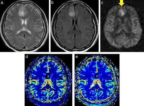 T WI A FLAIR B Relative Perfusion Map Derived From ASL C And