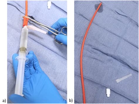 A Simple Method Of Unclogging Enteral Feeding Tubes Even When
