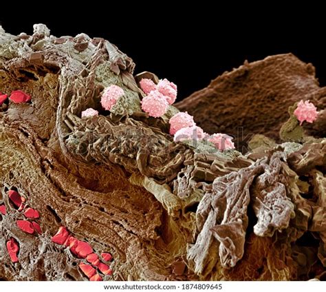 Pyoderma Skin Disease Under Color Scanning Stock Illustration