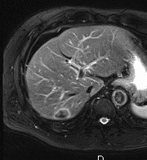 Usefulness Of Eob Mri For Treating Intrahepatic Cholangiocellular Carcinoma Bayer Liver360