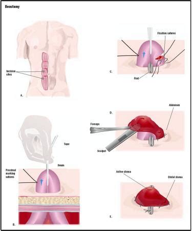 Loop Ileostomy Closure