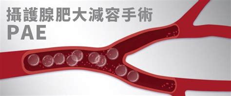 長安攝護腺動脈栓塞中心