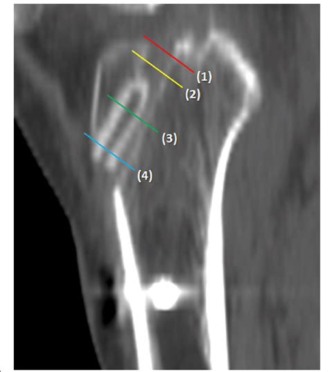 Cross Sectional Area Was Measured At The Four Cutting Levels Of Tibial Download Scientific