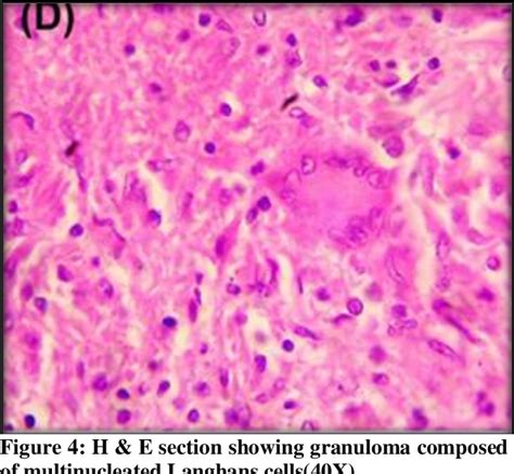 Figure 4 From A Case Series Of Extrapulmonary Tuberculosis Masquerading