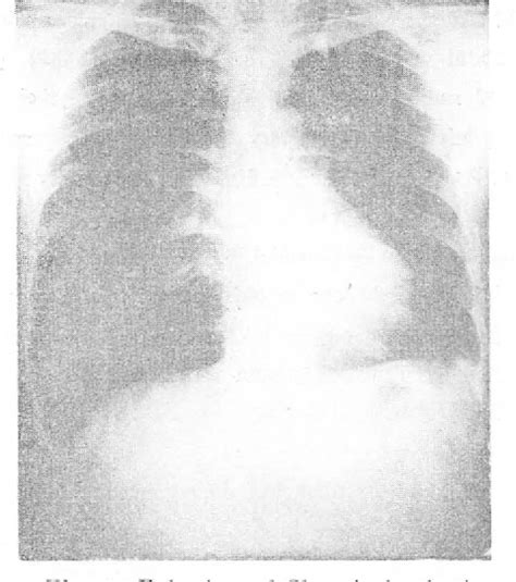 Figure 5 From Idiopathic Unilateral Hyperlucent Lung The Swyer James Syndrome Semantic Scholar