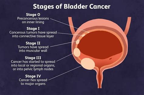 Stages Of Bladder Cancer Medizzy