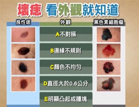 癌從外觀看！醫曝「5黑痣」恐變皮膚癌長在這些點＝警戒區 Ettoday健康雲 Ettoday新聞雲