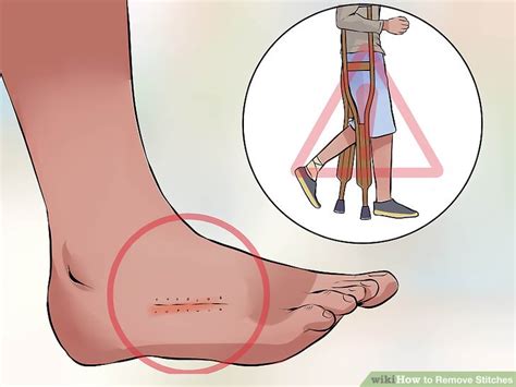 How To Remove Stitches 15 Steps With Pictures Wikihow