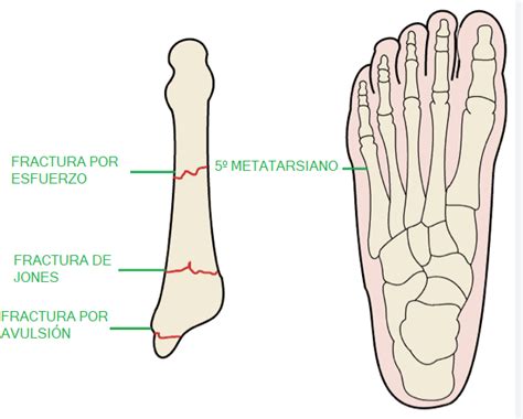 Fractura Del 5 Metatarsiano Sanfis Fisioterapia