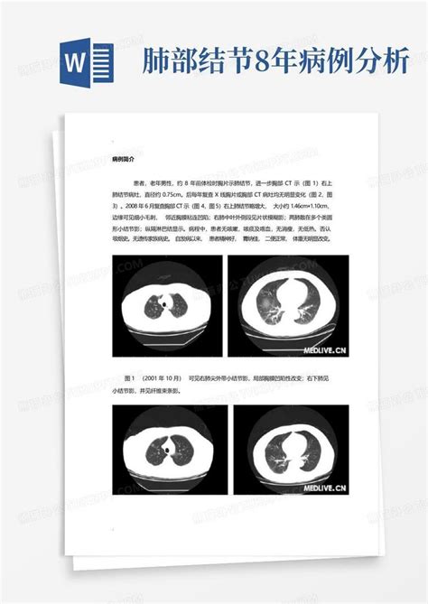 肺部结节8年病例分析word模板下载编号qmozjvzo熊猫办公