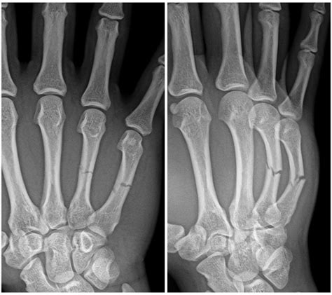 Stress Fracture Metacarpal Symptoms At Blair Martin Blog