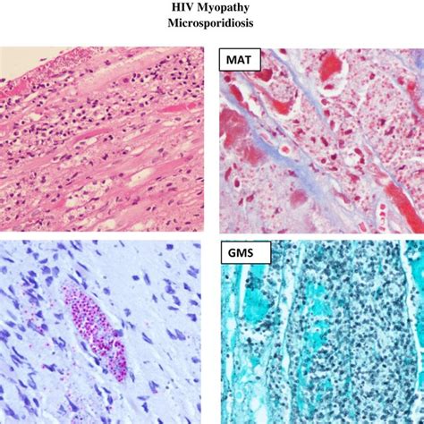 A Case Of Microsporidial Myositis In Hiv Infected Patient Showing Dense Download Scientific