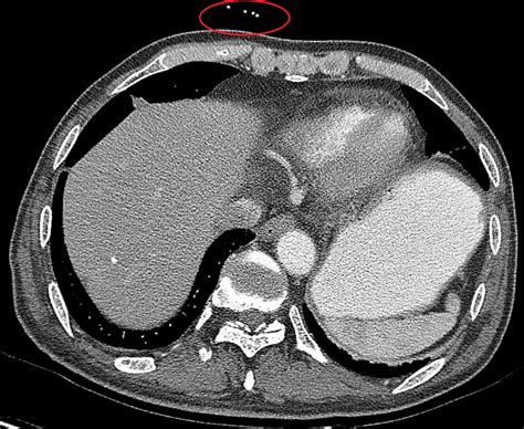 医学图像体外定位贴