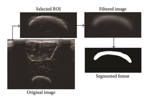A Representative Result Of Roi Selection Guided Filtering And Femur