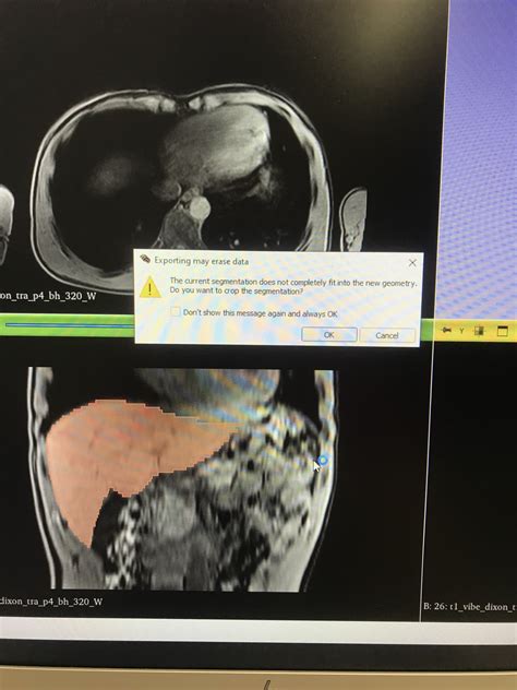 Segmentation Does Not Fit Into New Geometry Support 3d Slicer Community