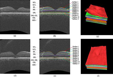 Segmentation Results Of 11 Intra Retinal Surfaces 10 Layers On A Download Scientific Diagram