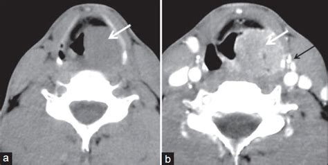Imaging Spectrum Of Hemangioma And Vascular Malformations Of The Head
