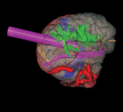 Progressive Symptoms Point To The Resection Of A Deep Thalamic Cavernous Malformation Nyu