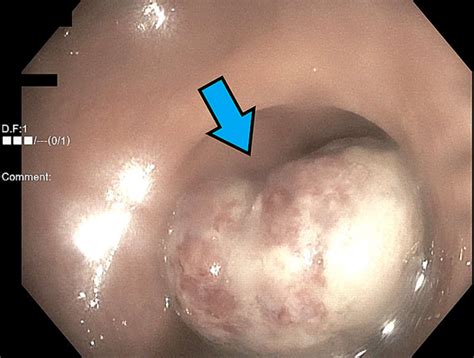 Juvenile Retention Polyp In A Teenager Pmc