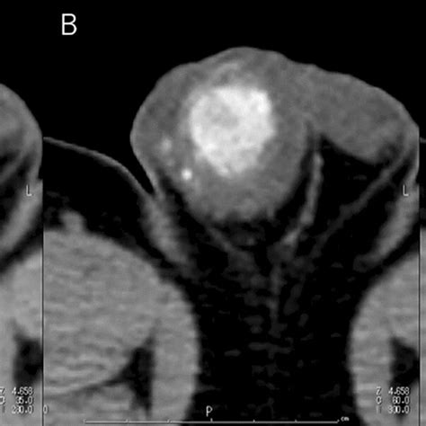 A Non Tumorous Testicular Parenchyma In The Affected Testis Hande