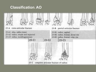 Distal Radius Fracture Fixed Angle Volar Plate Pptx