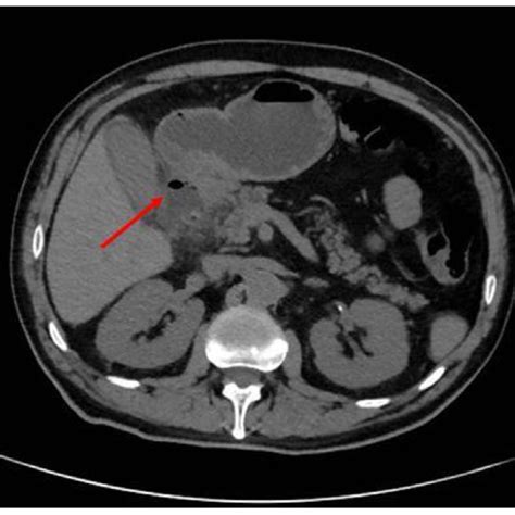 Surgical Treatment Algorithm For Zollinger Ellison Syndrome Zes
