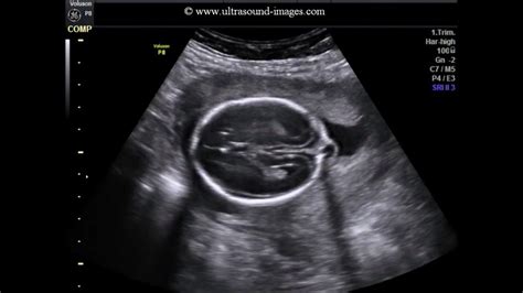 Encephalocele Ultrasound