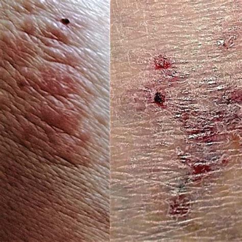 Lesiones De Micosis Fungoide En Diferentes Sitios Del Cuerpo Se